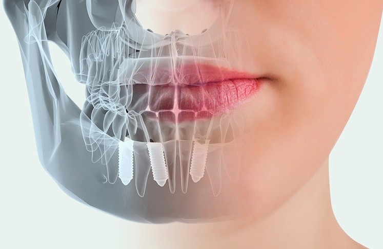 Periimplantitis: qué es, cómo detectarla y causas | Almara Dental